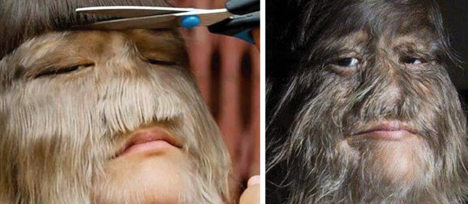 La niña más peluda del mundo, que tras conocer el amor decidió ...